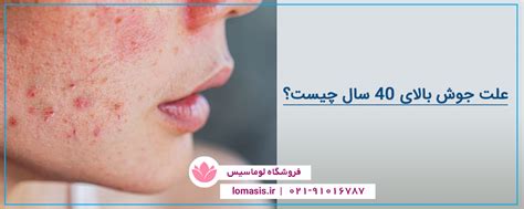 علت جوش بالای 40 سال چیست؟ به همراه روش های درمان جوش صورت در بزرگسالی