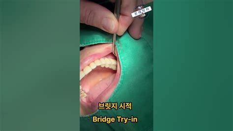 브릿지 보철로 빠진 치아 해넣기 치과치료 보철치료 브릿지보철 임플란트 치과의사 Prosthesis