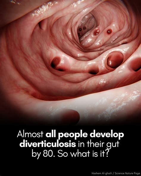 Hashem 70 Of People Develop Gut Pouches Called Diverticula By 80
