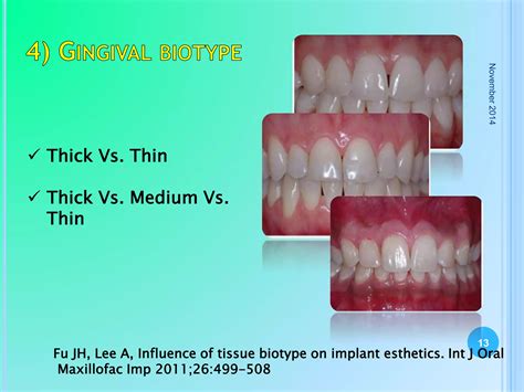 Fresh Socket Implant Placement Pptx