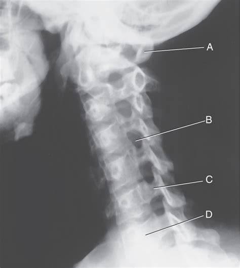 Oblique Cervical Spine Rpo Diagram Quizlet
