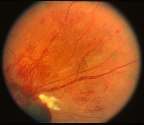 Retinal Neovascularization Retina Image Bank