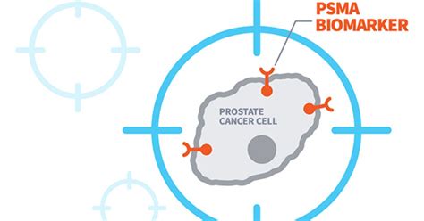Advances In Biomarker Testing Zero Prostate Cancer