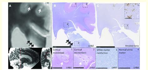 Diffuse T 2 Hyperintense Lesion In The Splenium Of The Corpus Download Scientific Diagram