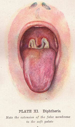 Difteria Causas Síntomas Y Tratamiento