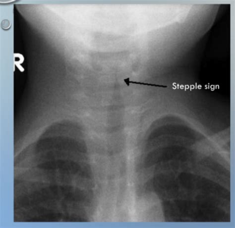 Pediatric Cough Flashcards Quizlet