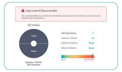 Oct In Glaucoma Ai Powered