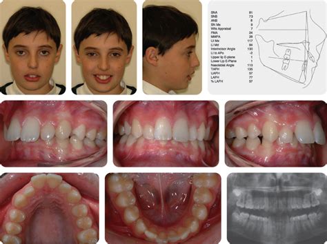 4 Class Ii Division 1 Malocclusion Pocket Dentistry
