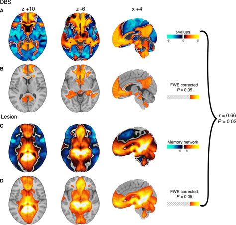 A Brain Network For Deep Brain Stimulation Induced Cognitive Decline In Parkinsons Disease