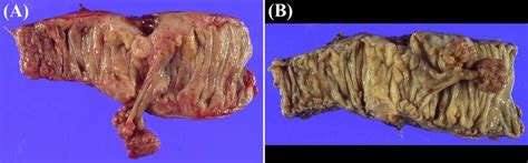 Macroscopic Pathological Examination Demonstrates A Sigmoid Colon Polyp Download Scientific