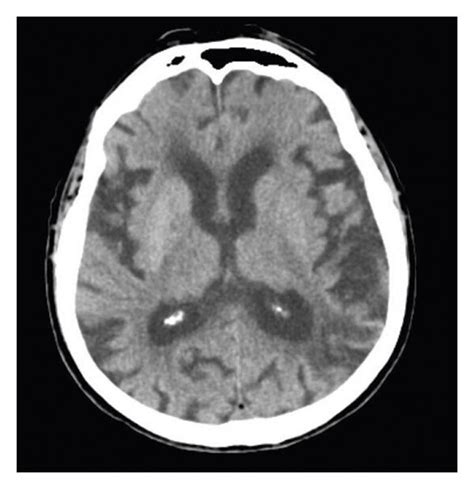 Patients Noncontrast Brain Computed Tomography Download Scientific Diagram