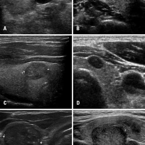 The Bethesda System For Reporting Thyroid Cytopathology Download Table
