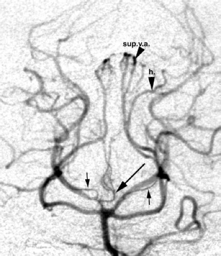 The Posterior Cerebral Artery Neupsy Key