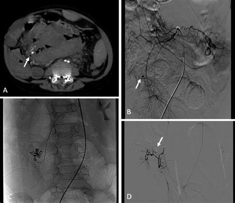 Coil Embolization And Mri At Richard Armes Blog