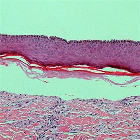 Subepidermal Separation With A Flattened Epidermis And Mild Download Scientific Diagram