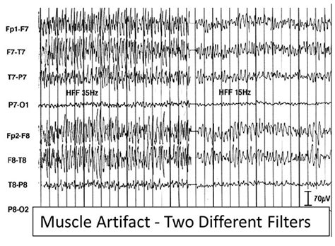 Strategies To Reduce Eegqeeg Artifacts