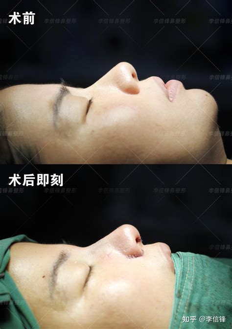 初鼻大鼻头宽鼻案例深圳李信锋隆鼻整形 知乎