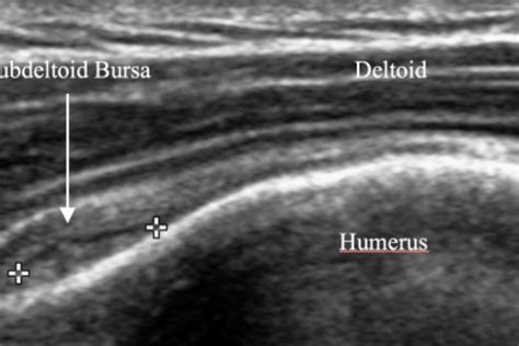 Subdeltoid Bursitis