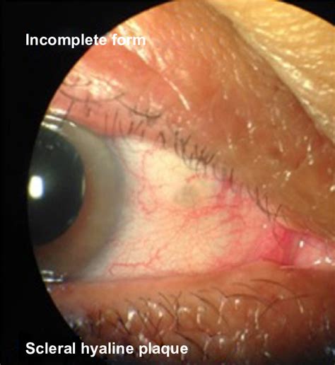 Ct Of Scleral Plaques
