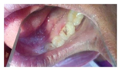 Photograph Showing The Fracture Of The Cusp 36 At The End Of The Download Scientific Diagram