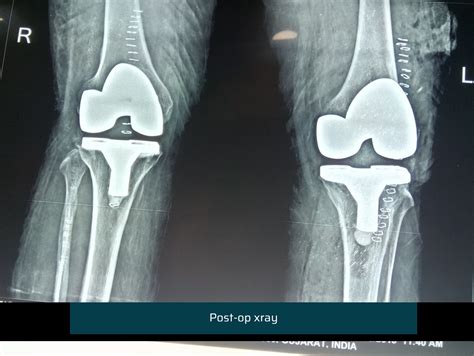 Complex Primary Total Knee Replacement Surgery Dr Rachit Sheth