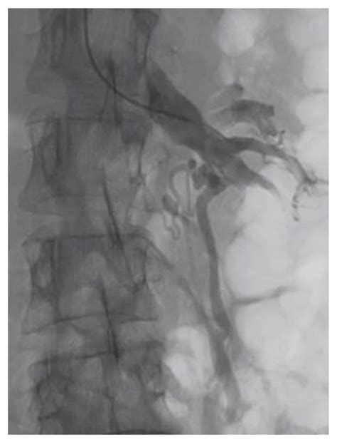 Nutcracker Syndrome Radiology