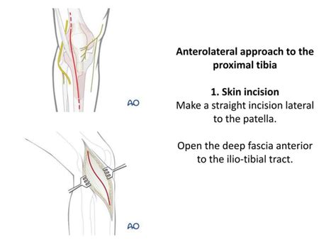Proximal Tibia Approachpptx