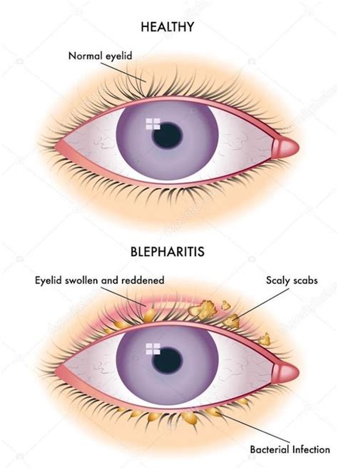 Blepharitis Carlton Stanley Opticians Shevington Wigan