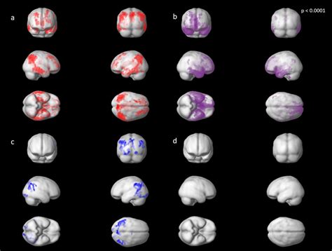 Voxel Wise Statistical Analysis Of Groups Of Interest Versus Download Scientific Diagram
