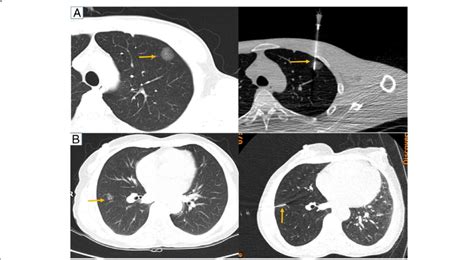 Computed Tomography Guided Semi Rigid Single Hook Wire Localization A Download Scientific