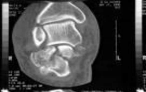 48 Ct Scan Show Displaced Intraarticular Calcaneal Fractures Download Scientific Diagram