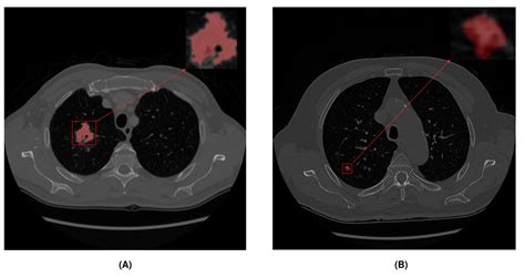 Statistical Analysis Of Nnu Net Models For Lung Nodule Segmentation