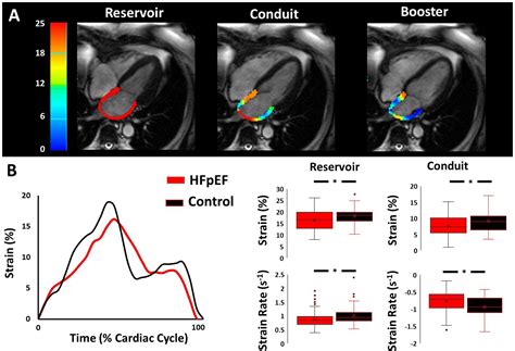 Left Atrial Stiffness Index Independently Predicts Exercise Intolerance
