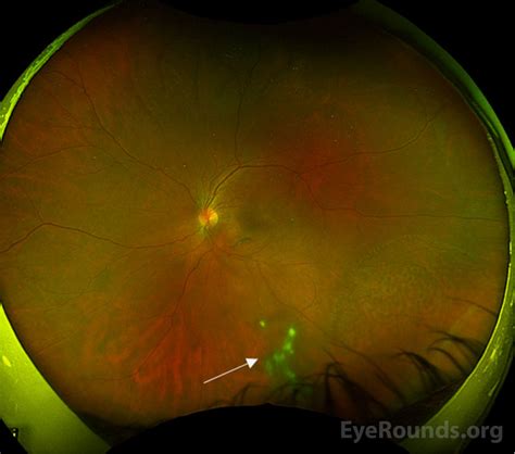 Intermediate Uveitis