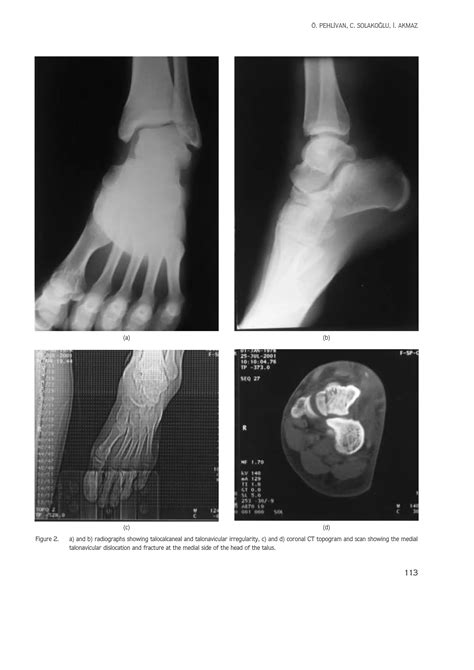 Subtalar Dislocation Pdf