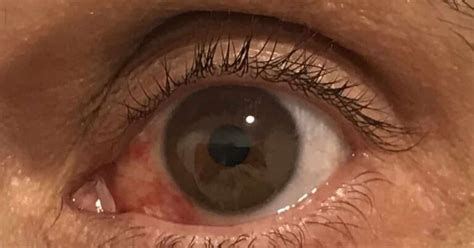 Causas Ojos Rojos Que Hacer Y Que Evitar Con El Dr Ollero