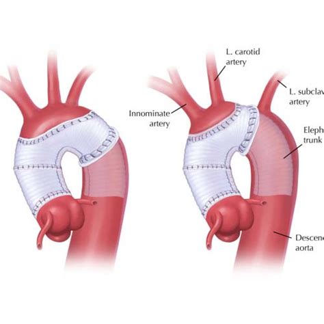 Aortic Surgery Dr Sivaraj Pillai Govindasamy
