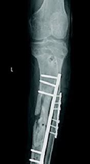 Effective Comminuted Fracture Treatment Expert Tips For A Speedy Recovery