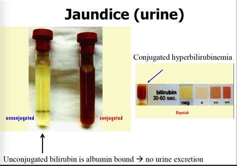 Bilirubin In Urine Color