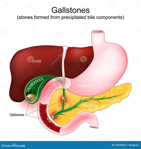 Gallstones And Human Silhouette Vector Illustration