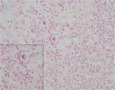 Orange Nodules On The Scalp Mdedge