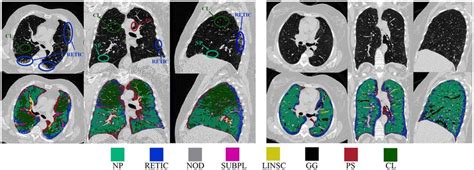 Automated Full Lung Classification Results Of Two Ct Scans With