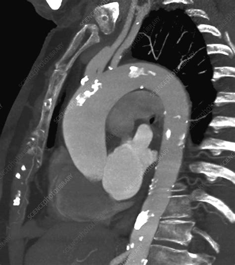 Aortic Aneurysm Ct Scan Stock Image C0529276 Science Photo Library