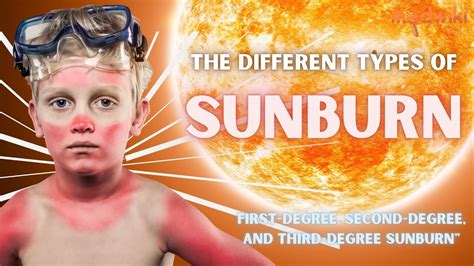 The Different Types Of Sunburn First Degree Second Degree And Third Degree Sunburn YouTube