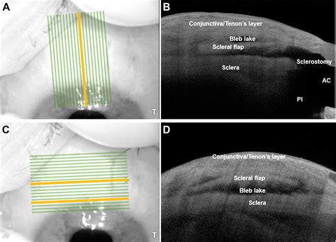 Visualization Of Scleral Flap Patency In Glaucoma Filtering Blebs Using