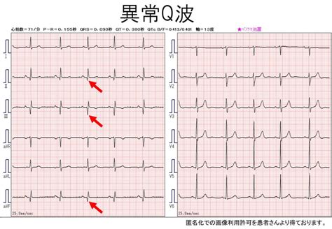 健診で心電図異常を指摘されたら異常Q波の場合 愛知県一宮市の循環器内科 愛北ハートクリニック