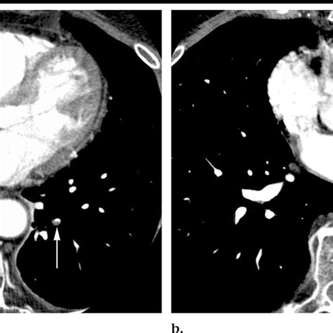 Subsegmental Pe And Calf Vein Thrombosis In A 54 Year Old Woman A Download Scientific
