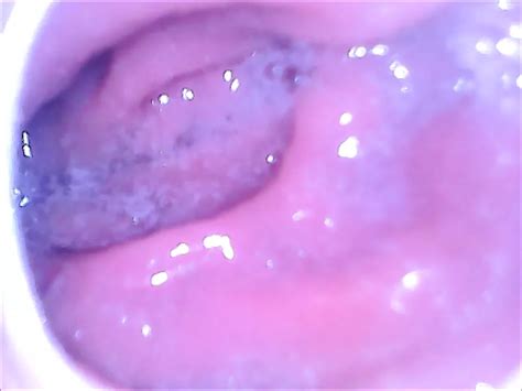 Free Endoscope Porn Videos Xhamster