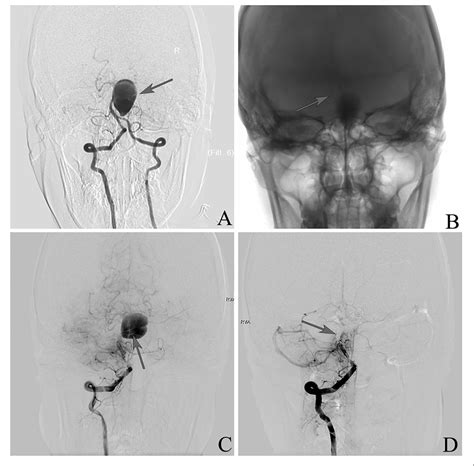 Figure 2 From Pipeline Embolization Device For The Treatment Of Unruptured Intracranial