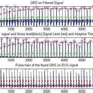 Detection Of QRS Complexes Download Scientific Diagram